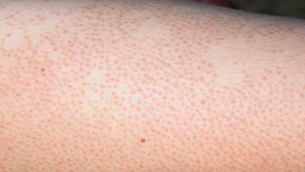 Si ves pintitas rojas en la piel, no te asustes