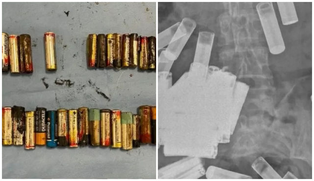 Médicos hacen radiografía a una mujer y descubren 55 pilas en su cuerpo