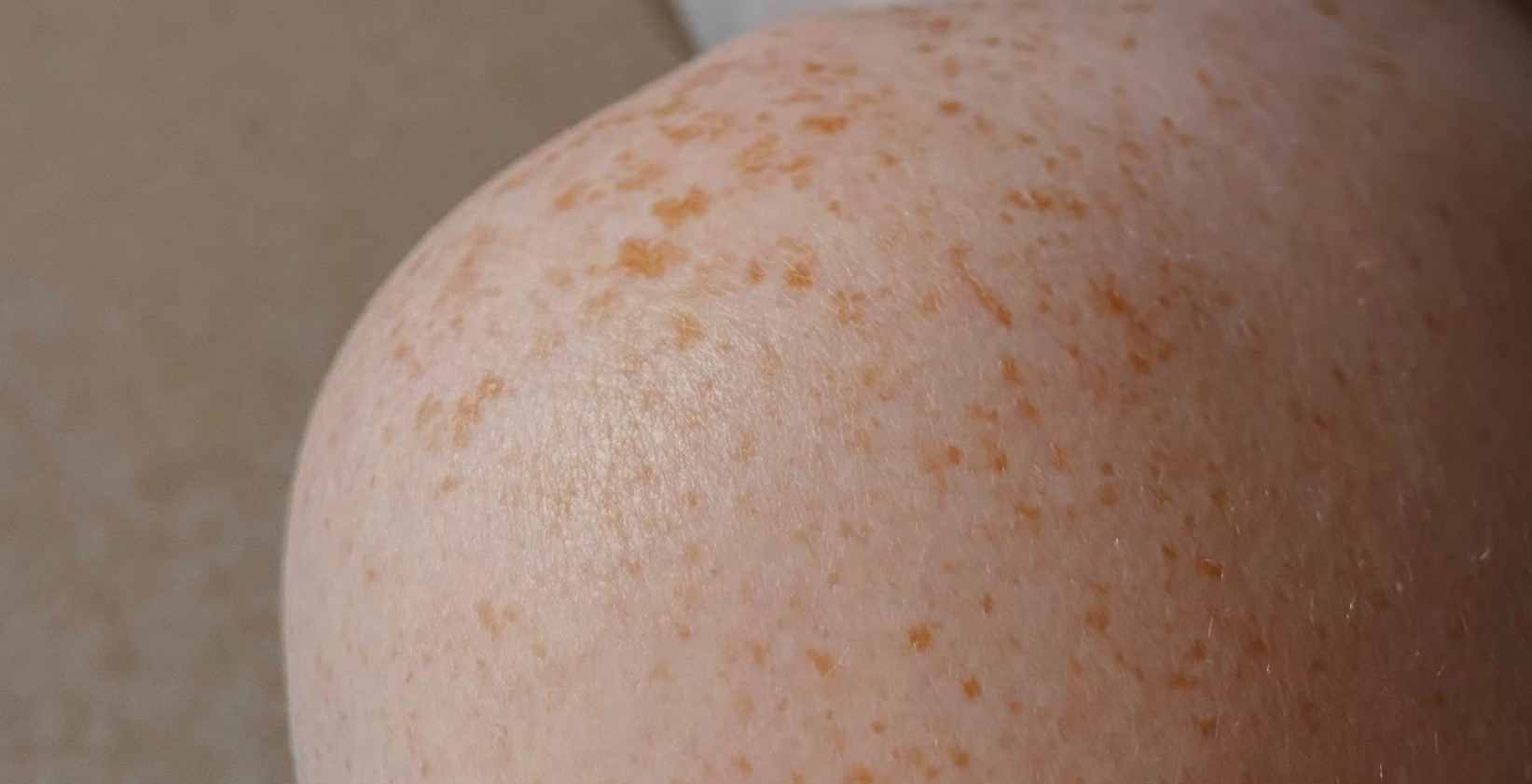 Una cuestión de piel - Canal-M - Montevideo Portal